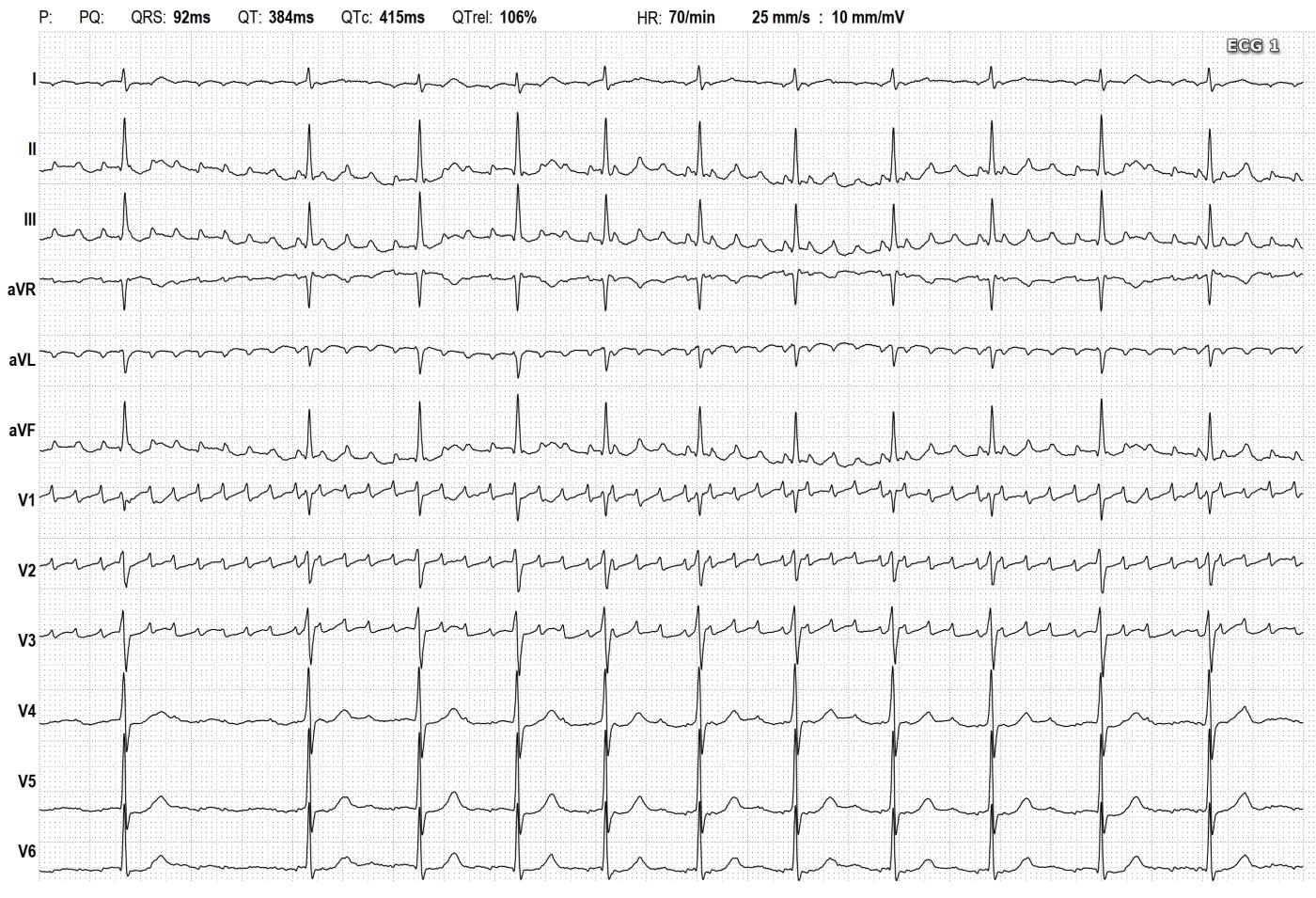 Atypical Atrial Flutter Ecg Guru Instructor Resources